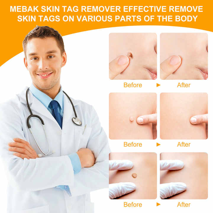 2 In1 Painless Auto Skin Tag Mole Removal Kit – produckpk